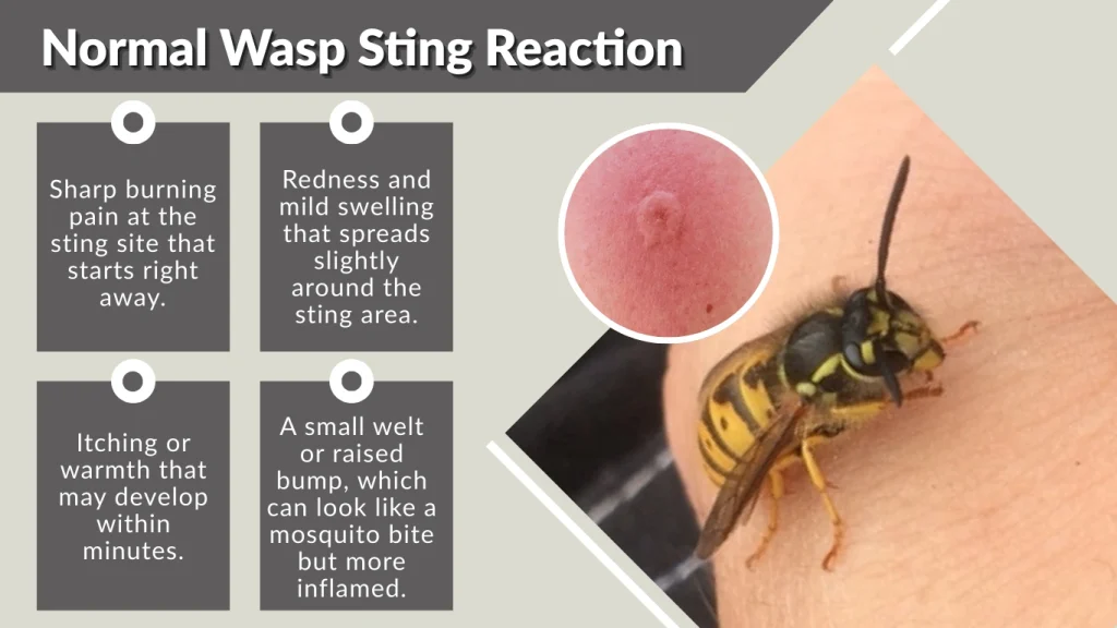 Normal Wasp Sting Reaction What Should You Do Immediately