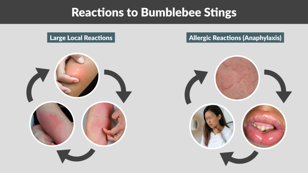 Bumblebee Sting: Identification, Symptoms, Reaction & Treatment