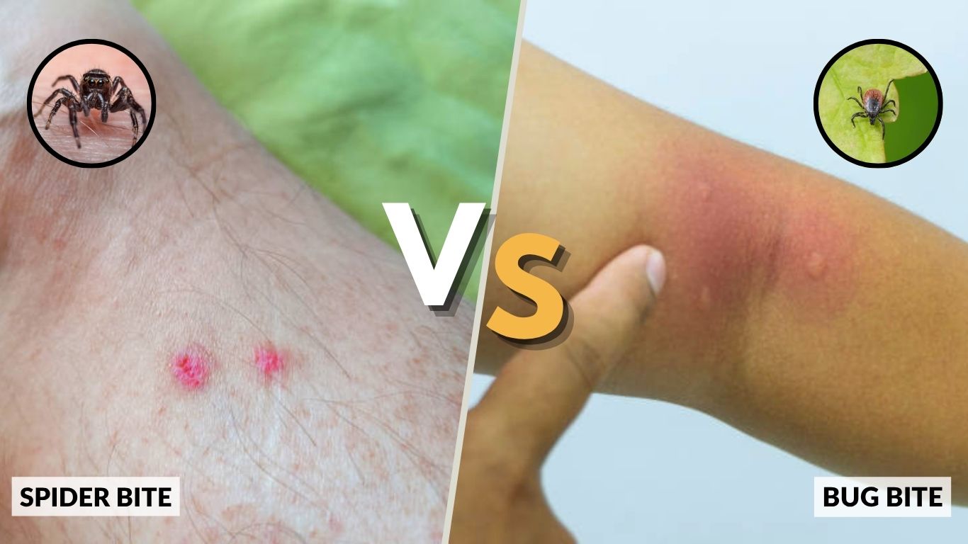 Spider Bite vs Bug Bite: Signs, Symptoms & Identification