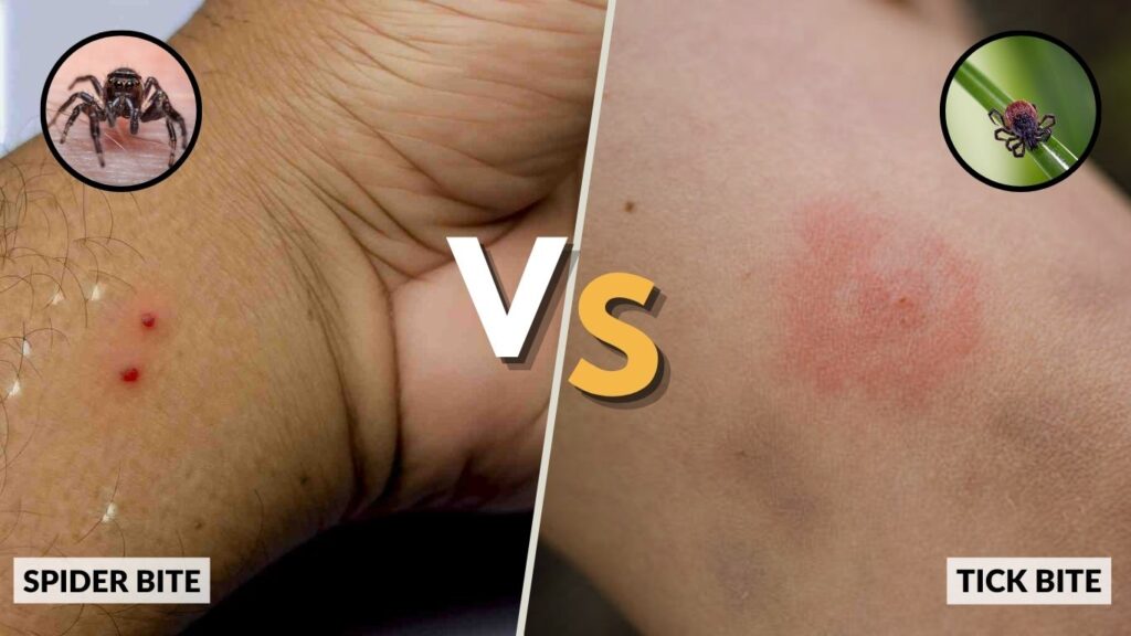 Spider Bite vs Tick Bite: Key Differences, Symptoms & Pictures